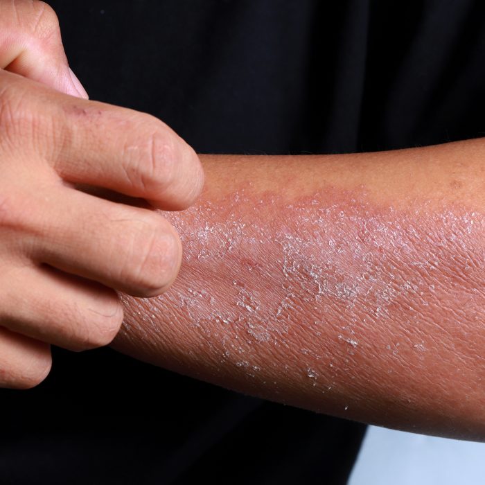 Dermatitis Atópica: Tratamiento y Remedios Naturales | ElBúhoVerde